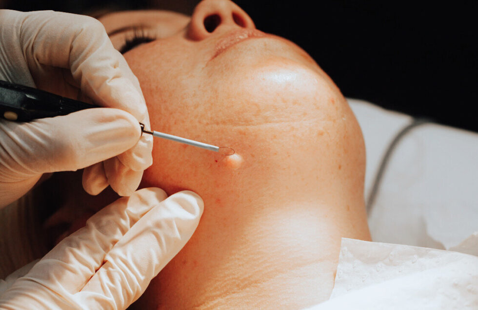 Skin Lesion Removal - Glow Up Clinic